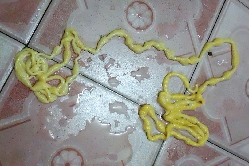 Pemuda keluarkan cacing pita 5 meter dari punggung selepas mengadu ...