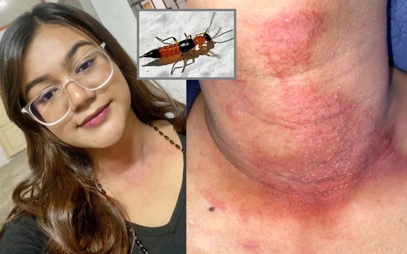 Leher bernanah angkara gigitan charlie, wanita tanggung azab macam kena ...