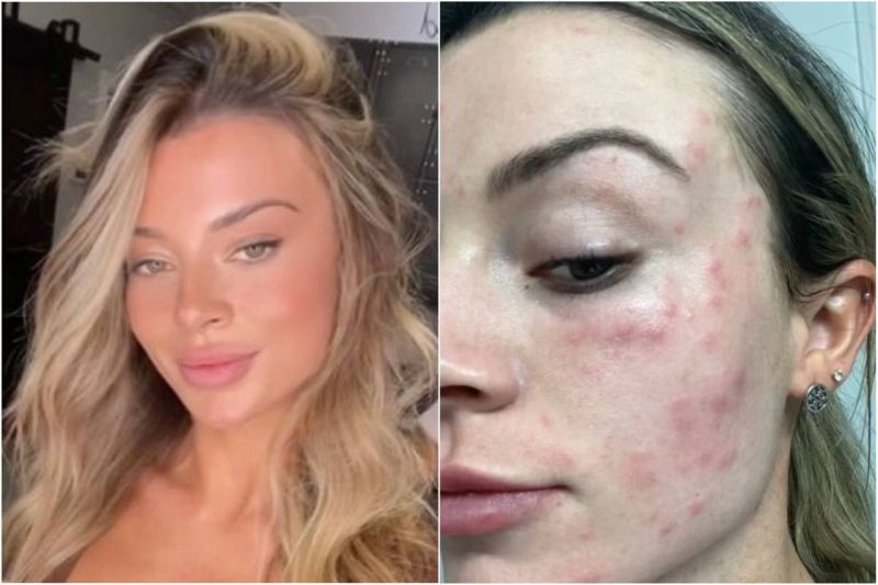 Wanita masuk hutan dihurungi nyamuk, muka jadi merah penuh ruam - Dunia ...