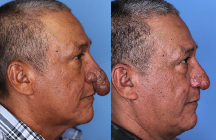 Derita 6 tahun berakhir... Tukang cat jalani pembedahan betulkan hidung ...