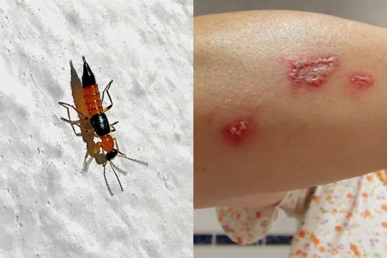 Charlie tak gigit tapi bahaya! Ini langkah pencegahan yang harus ...