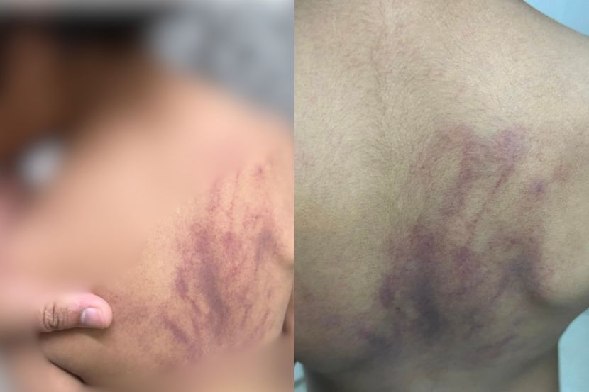 Badan merah-merah, kesan lebam teruk belakang badan! Anak autistik ...